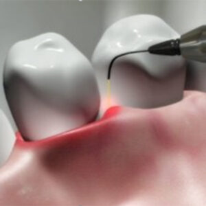 LANAP Treatment in South Ogden, UT, and Kaysville, UT